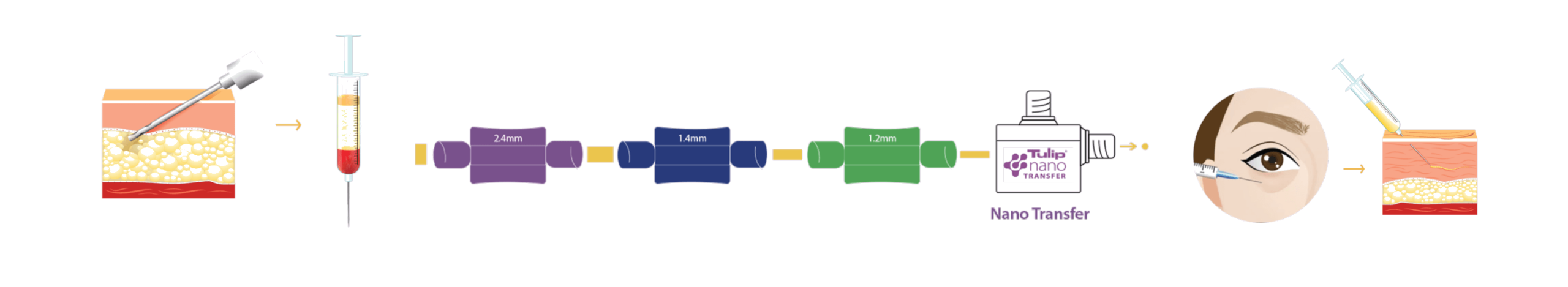 What Are Microfat & Nanofat? - Tulip Medical